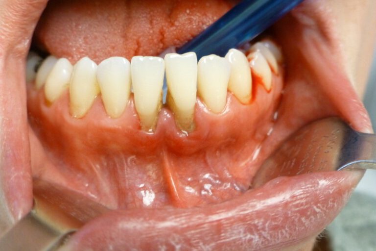 Zahnstein – Praxis Dr. Rademacher Rosendahl